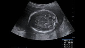 Apa beza 2D, 3D, 4D, 5D & 6D Ultrasound Scan - Ultrasound Scan - Bangi ...