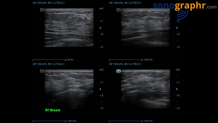 Breast Scan (Ultrasound Scan Payudara) - Ultrasound Scan - Bangi ...