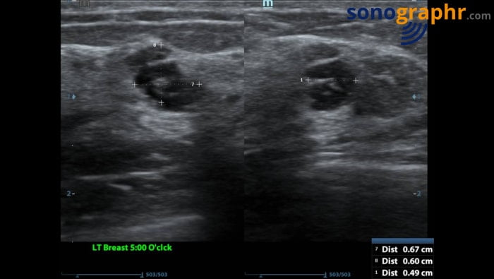 Breast Scan (Ultrasound Scan Payudara) - Ultrasound Scan - Bangi ...