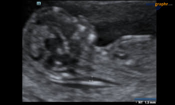Apa itu NT Scan atau Nuchal Translucency Scan? - Ultrasound Scan ...